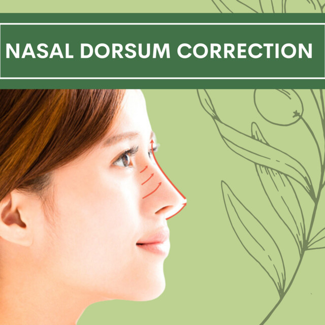 Nasal Dorsum Correction, pal, adajan, vesu, piplod, athwagate,bhatar ...